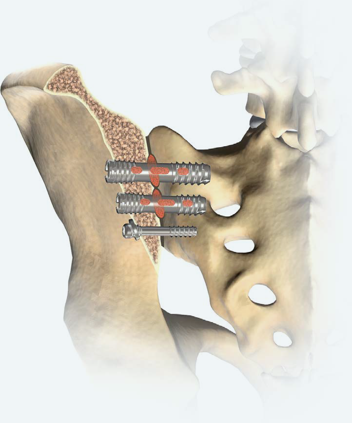 SI Joint Fusion | SI Joint Fusion Surgery | Dr. Kushwaha